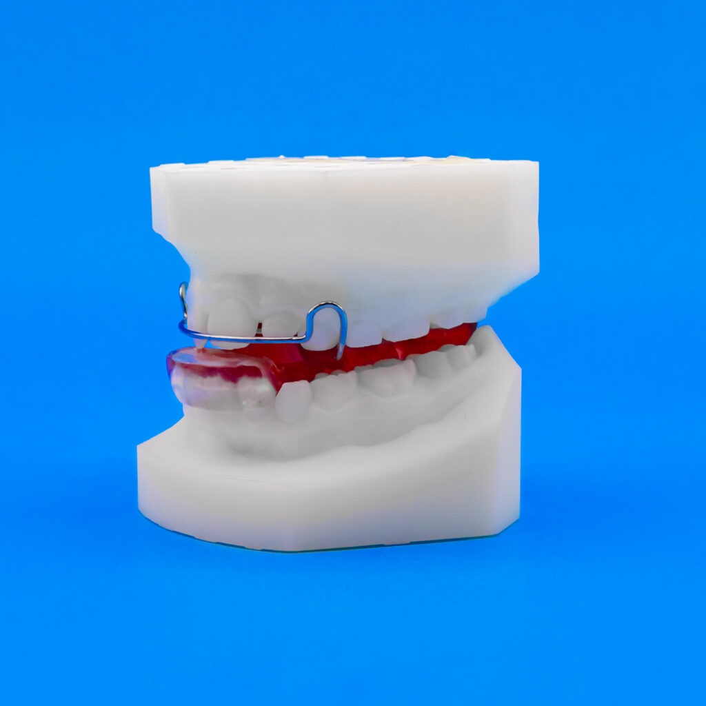 Bionator Appliance: Functional Class II Mandibular Advancement
