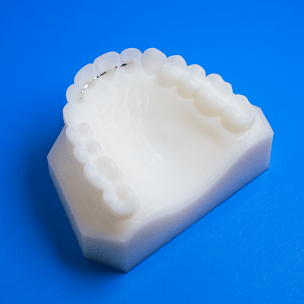 Composite Fixed Lingual Retainers - Specialty Appliances