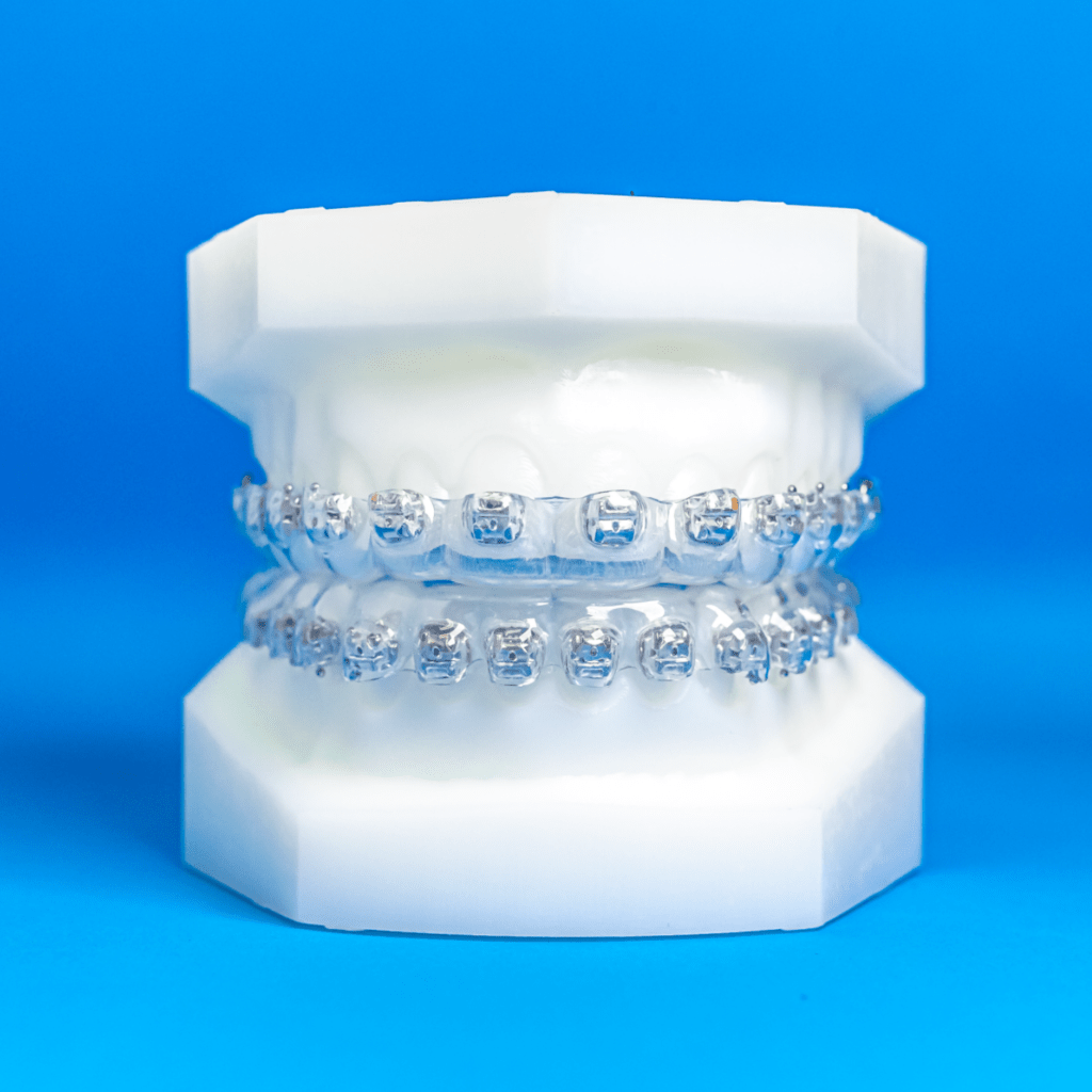 Traditional Indirect Bonding - Specialty Appliances