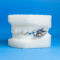 MARA Appliance: Crown-Based Mandibular Advancement for Class II