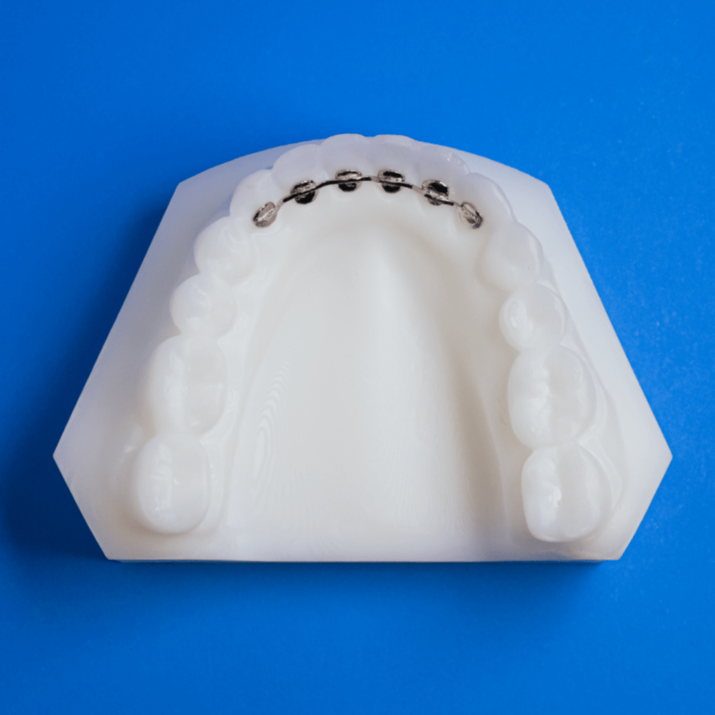 Mesh Fixed Lingual Retainers - Specialty Appliances