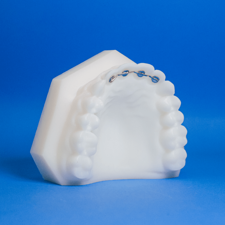 Mesh Fixed Lingual Retainer: Pad-Bonded Permanent Retainer