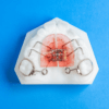 Pendex Appliance: Molar Distalization and Arch Expansion