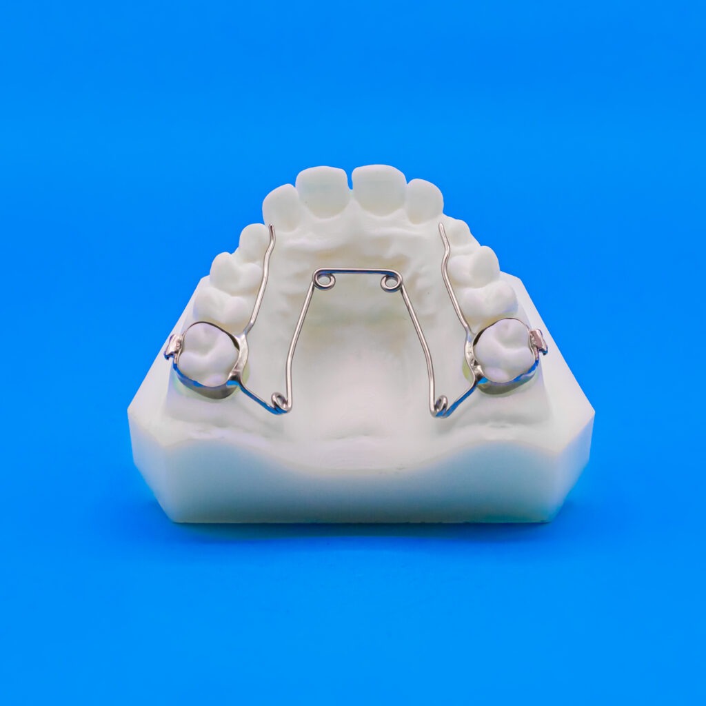 Quad Helix: Fixed Upper Arch Expansion Appliance