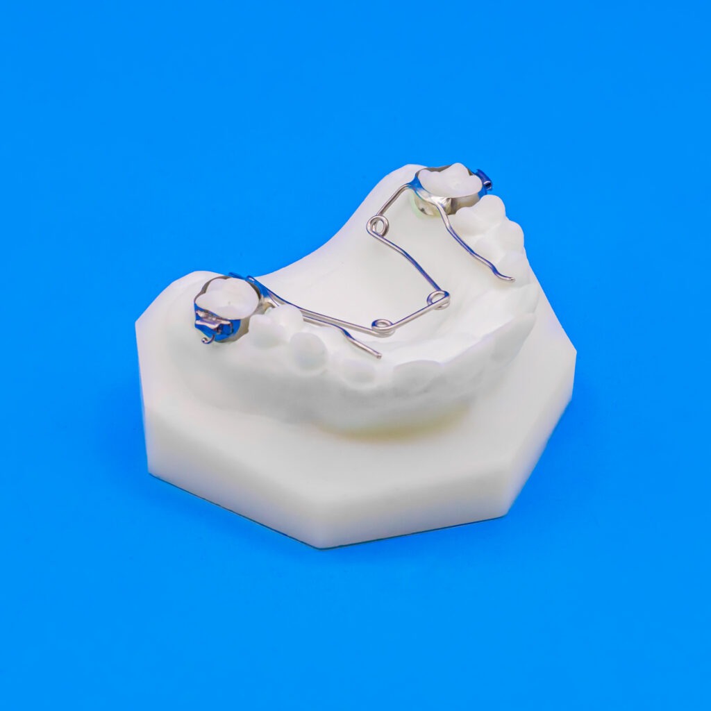 Quad Helix: Fixed Upper Arch Expansion Appliance