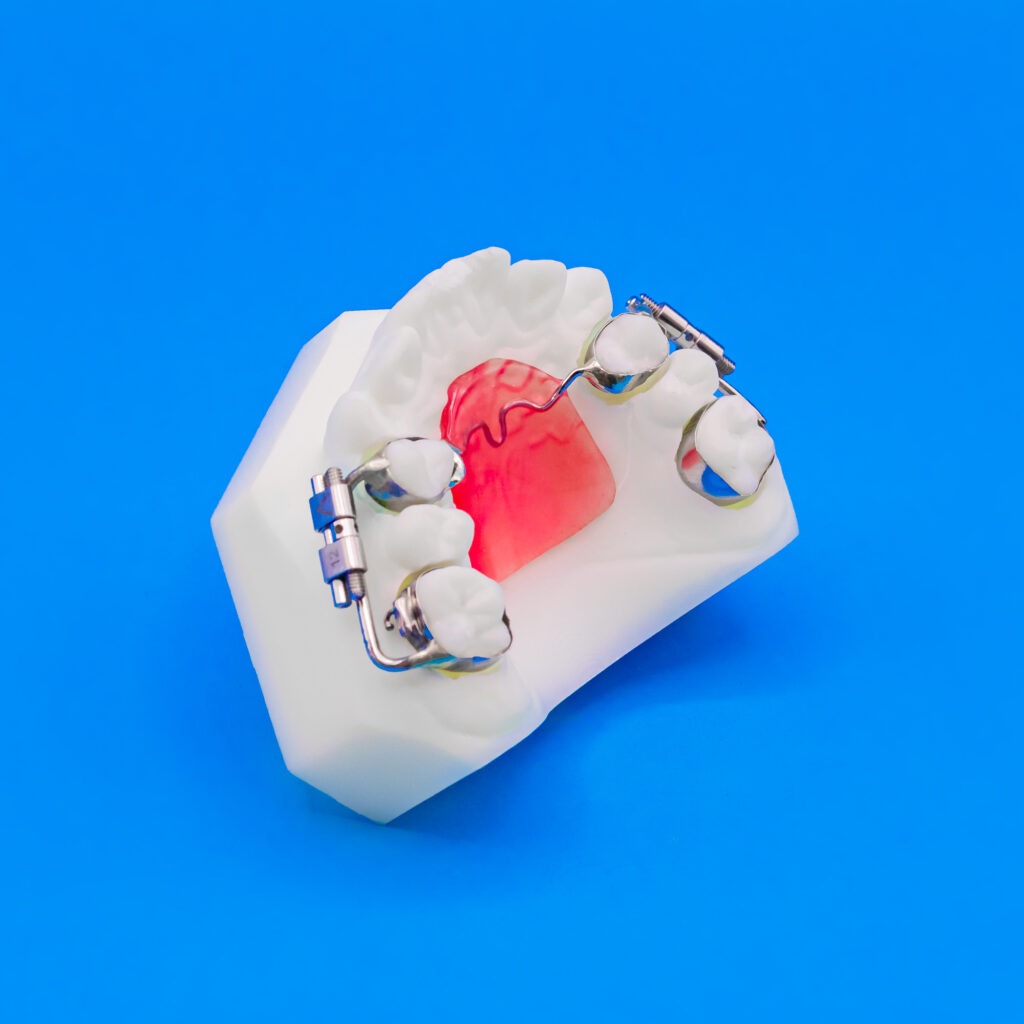 Rapid Molar Distalizer - Specialty Appliances