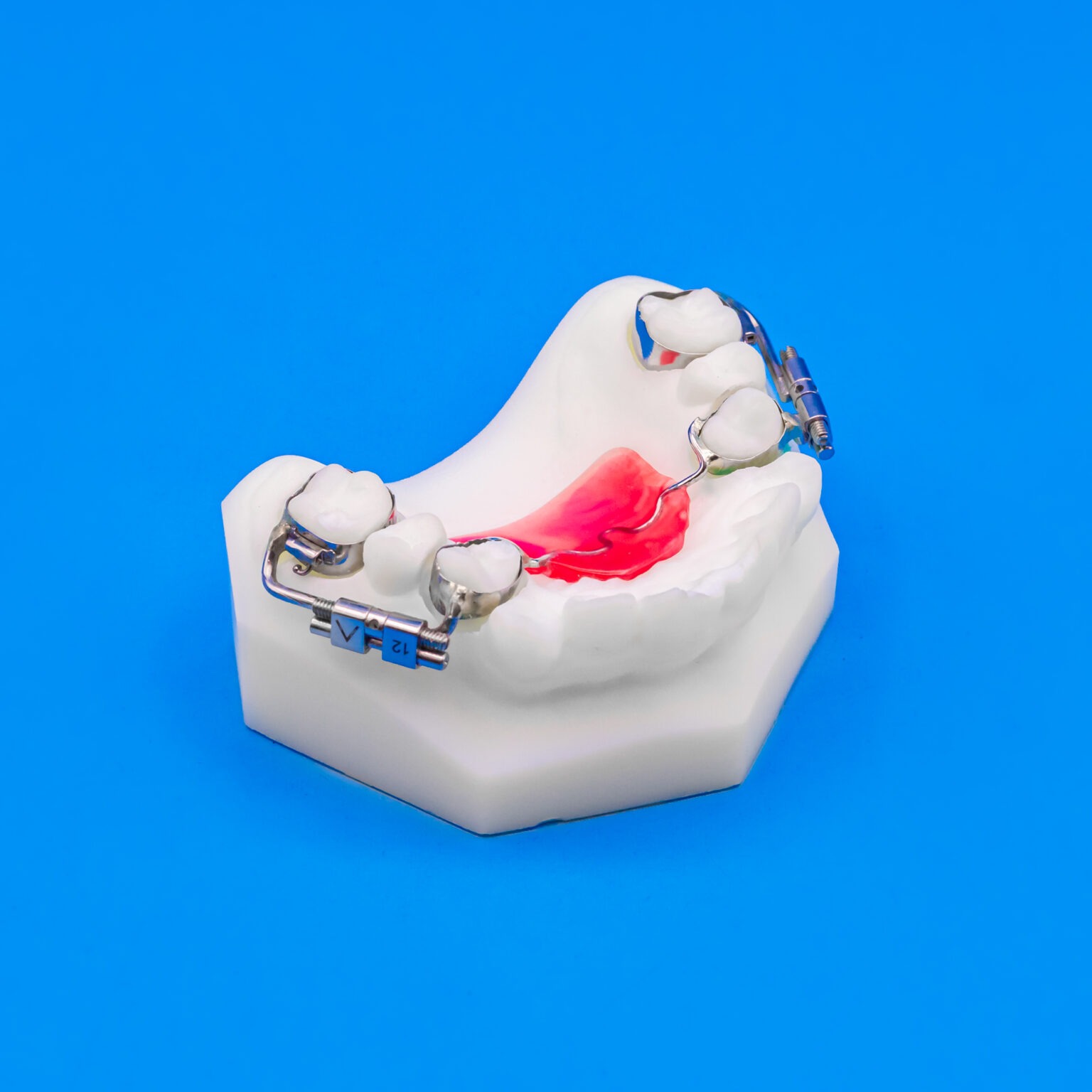 Rapid Molar Distalizer - Specialty Appliances