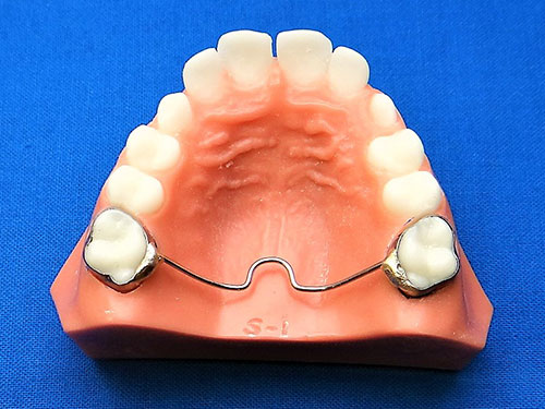 Transpalatal Arch - Specialty Appliances