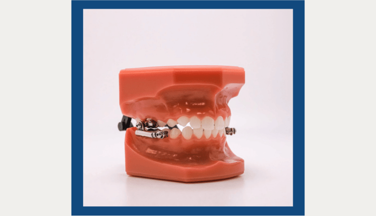 The Herbst Appliance for Class II Correction | Specialty Appliances