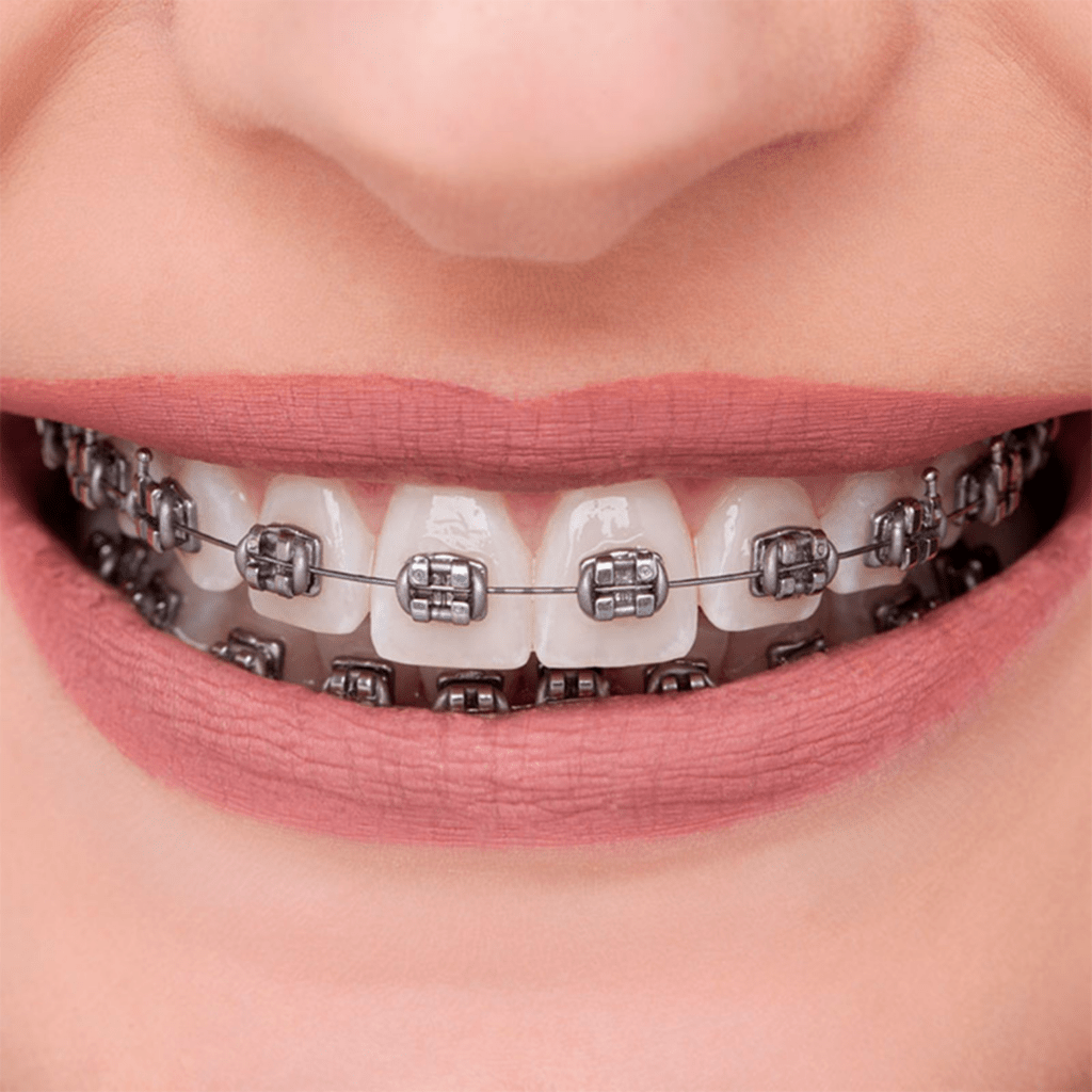 Advanced Series Roth .022 Brackets - Specialty Appliances