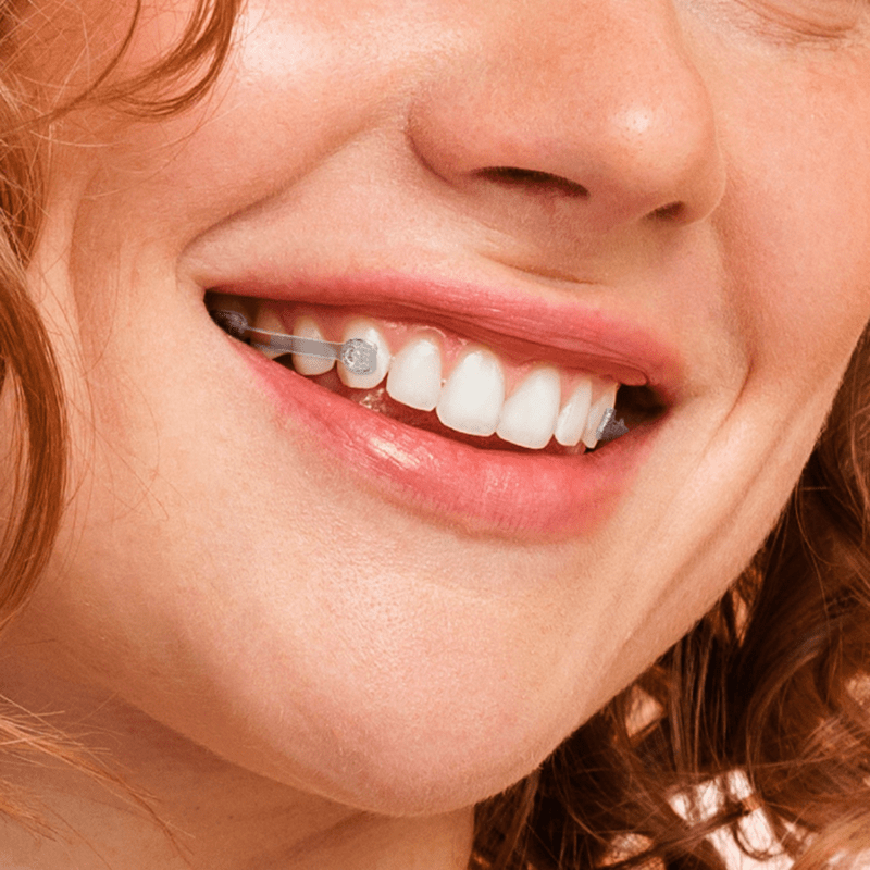 ICERam Class II Clear Distalizer - Specialty Appliances