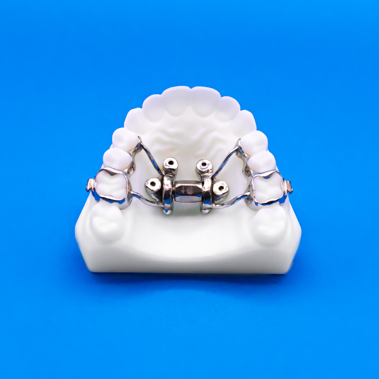 MARPE Appliance: Custom 3D Printed Mini-Screw Palatal Expander
