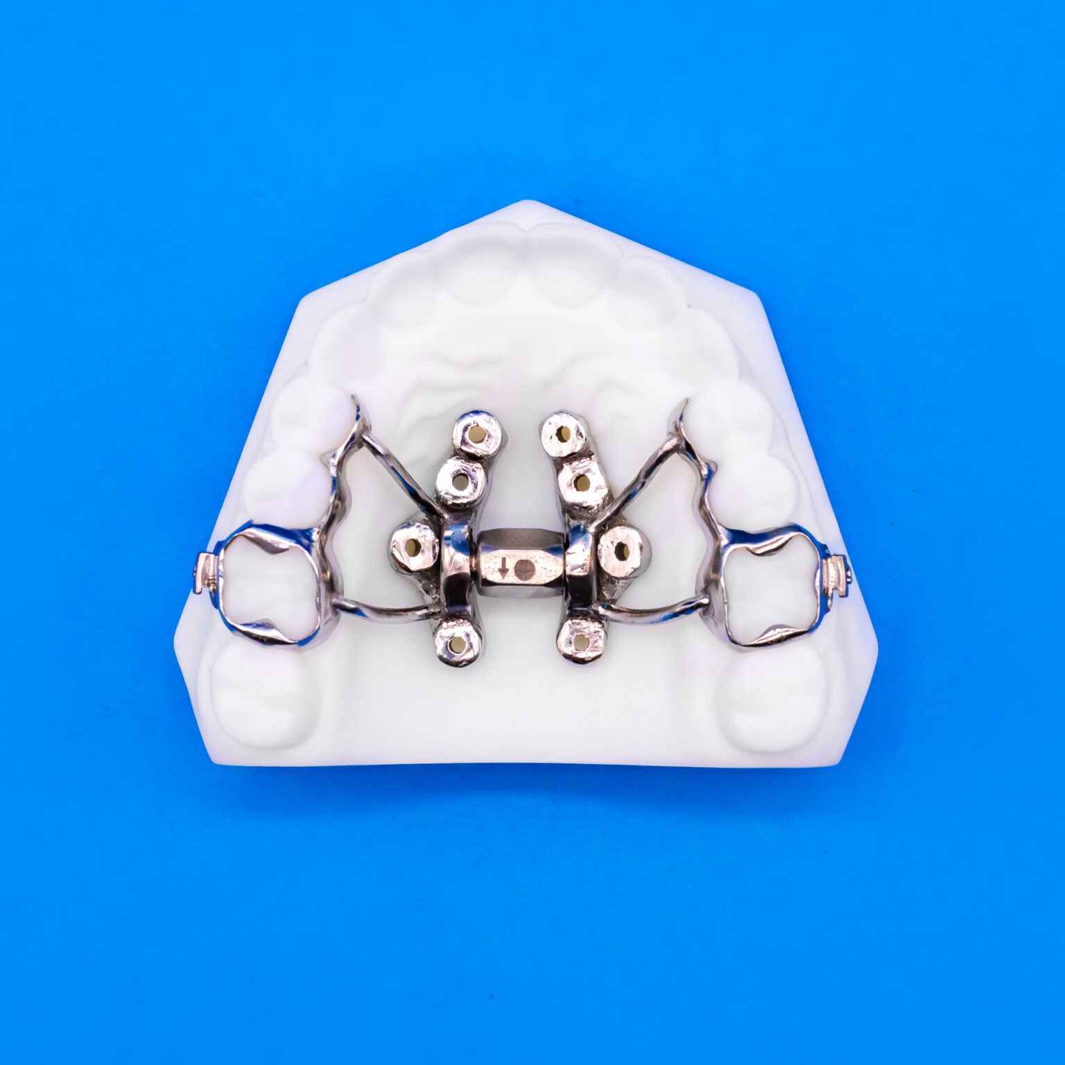 MARPE Appliance: Custom 3D Printed Mini-Screw Palatal Expander